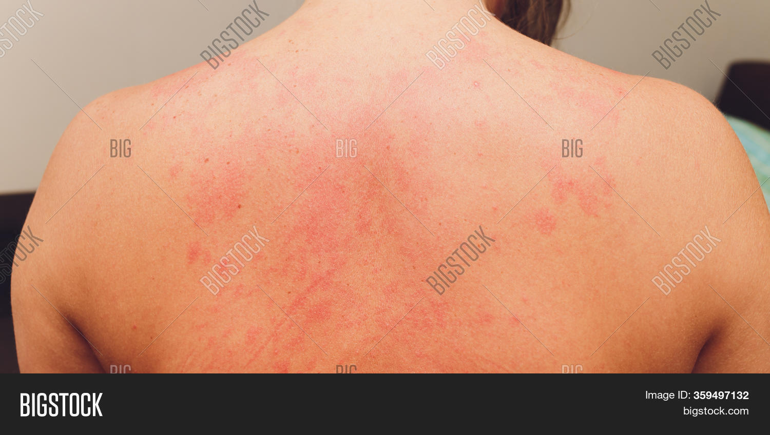 Allergic Rash On Body Image & Photo (Free Trial) | Bigstock