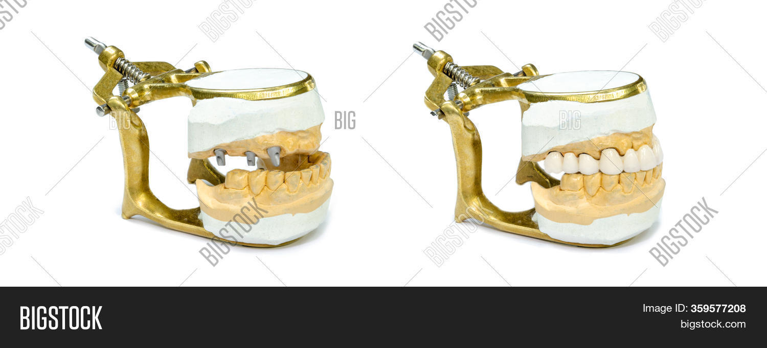 Jaw Models Dental Image & Photo (Free Trial) | Bigstock