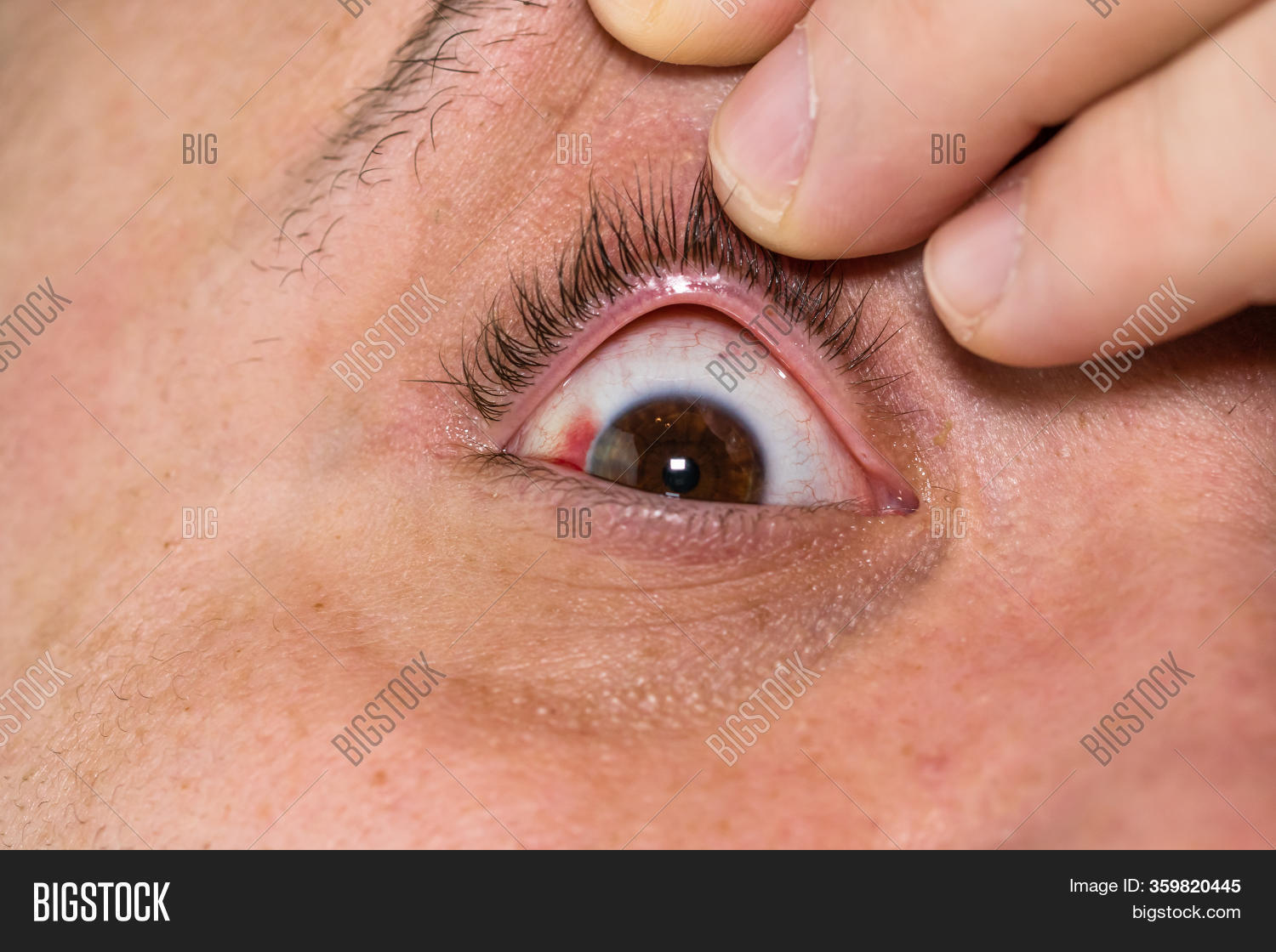 Eye Injury, Young Man Image & Photo (Free Trial) | Bigstock