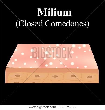 Closed Comedones. Vector & Photo (Free Trial) | Bigstock