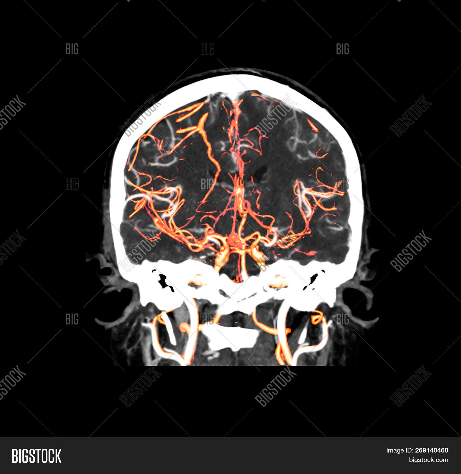 Ct Angiography Brain Image & Photo (Free Trial) | Bigstock