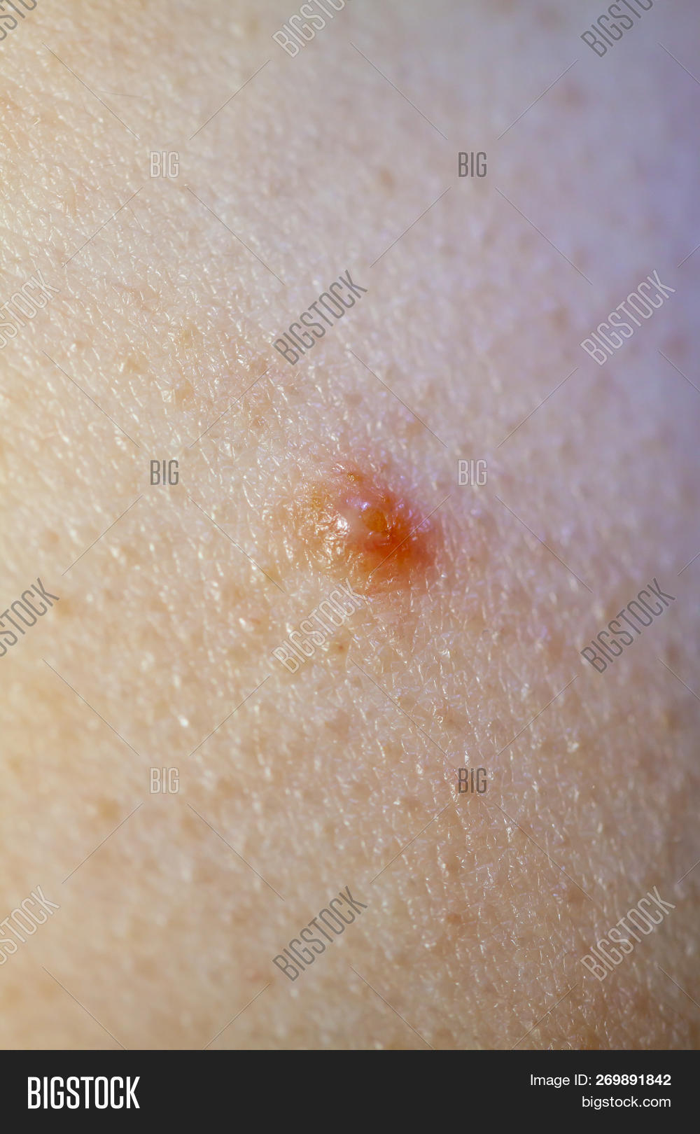 Close Molluscum Image & Photo (Free Trial) | Bigstock