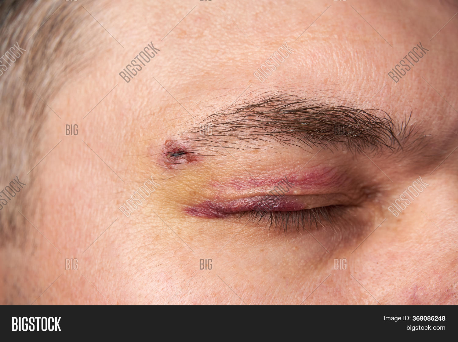 Close View Bruise Near Image & Photo (Free Trial) | Bigstock