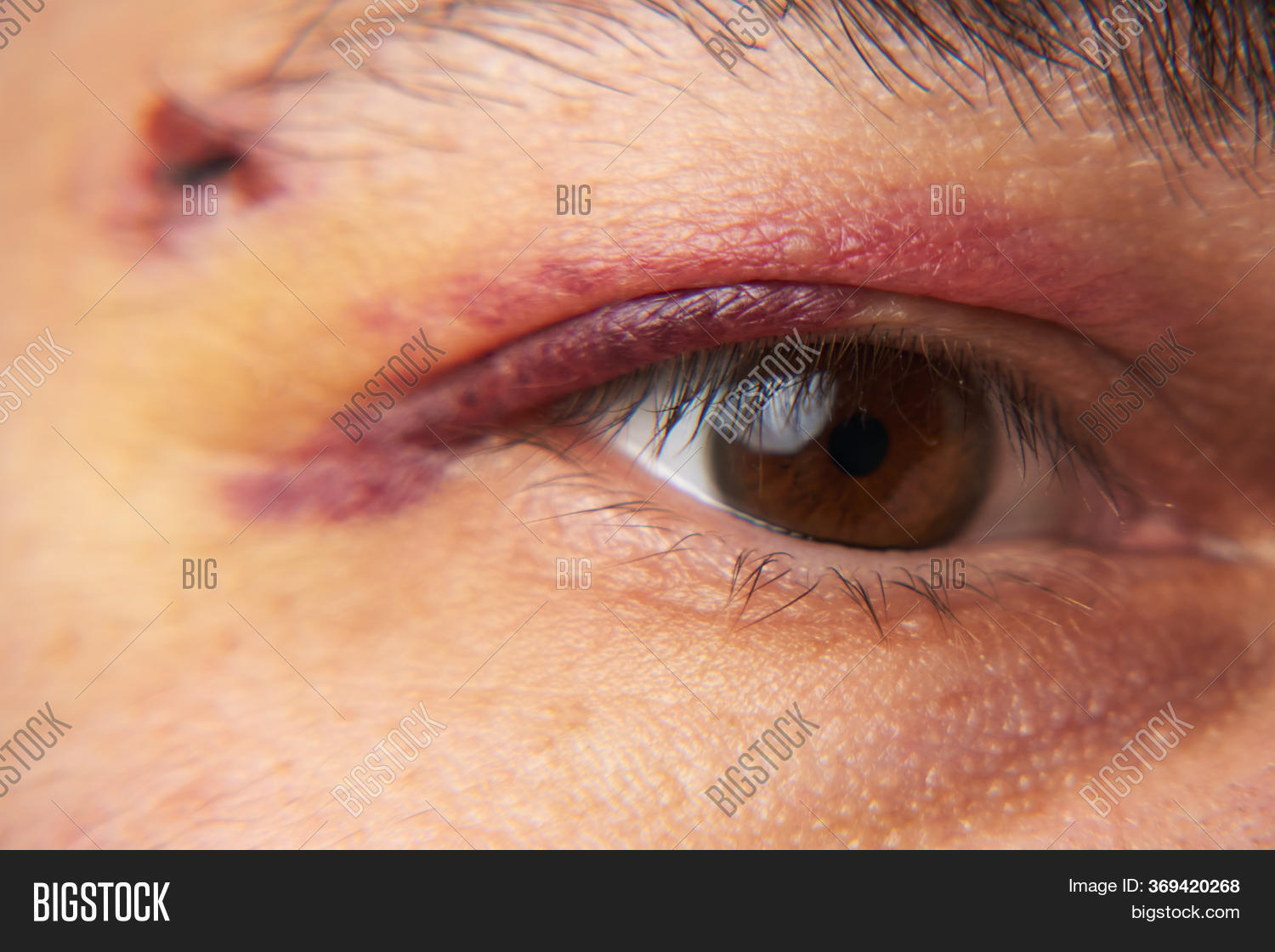 Close View Bruise Near Image & Photo (Free Trial) | Bigstock