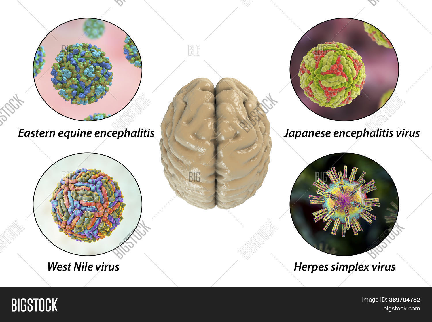 Brain Infections, Image & Photo (Free Trial) | Bigstock