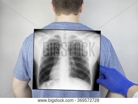 Chest X-ray Man Back. Image & Photo (Free Trial) | Bigstock