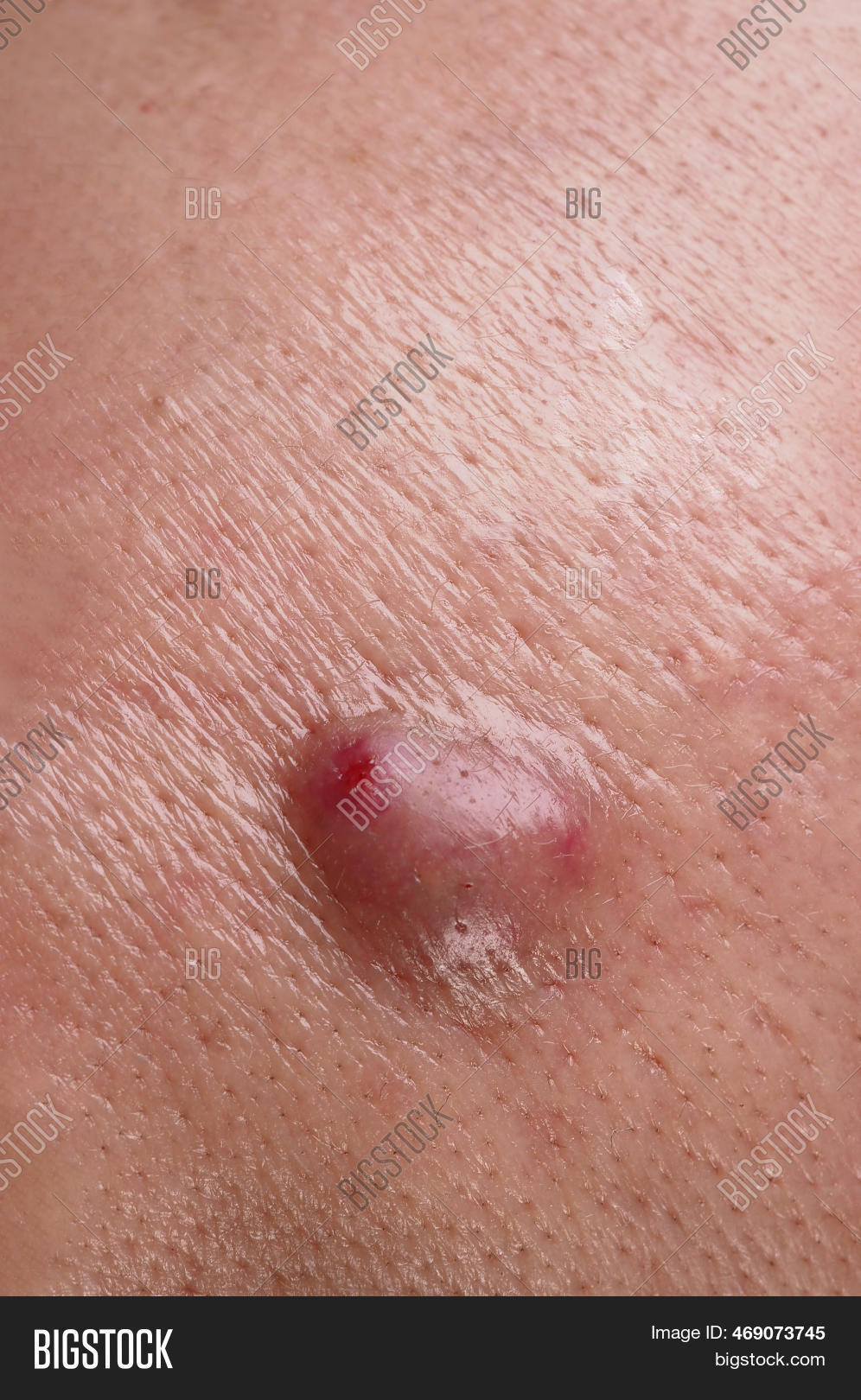 Swollen Pimple Under Skin