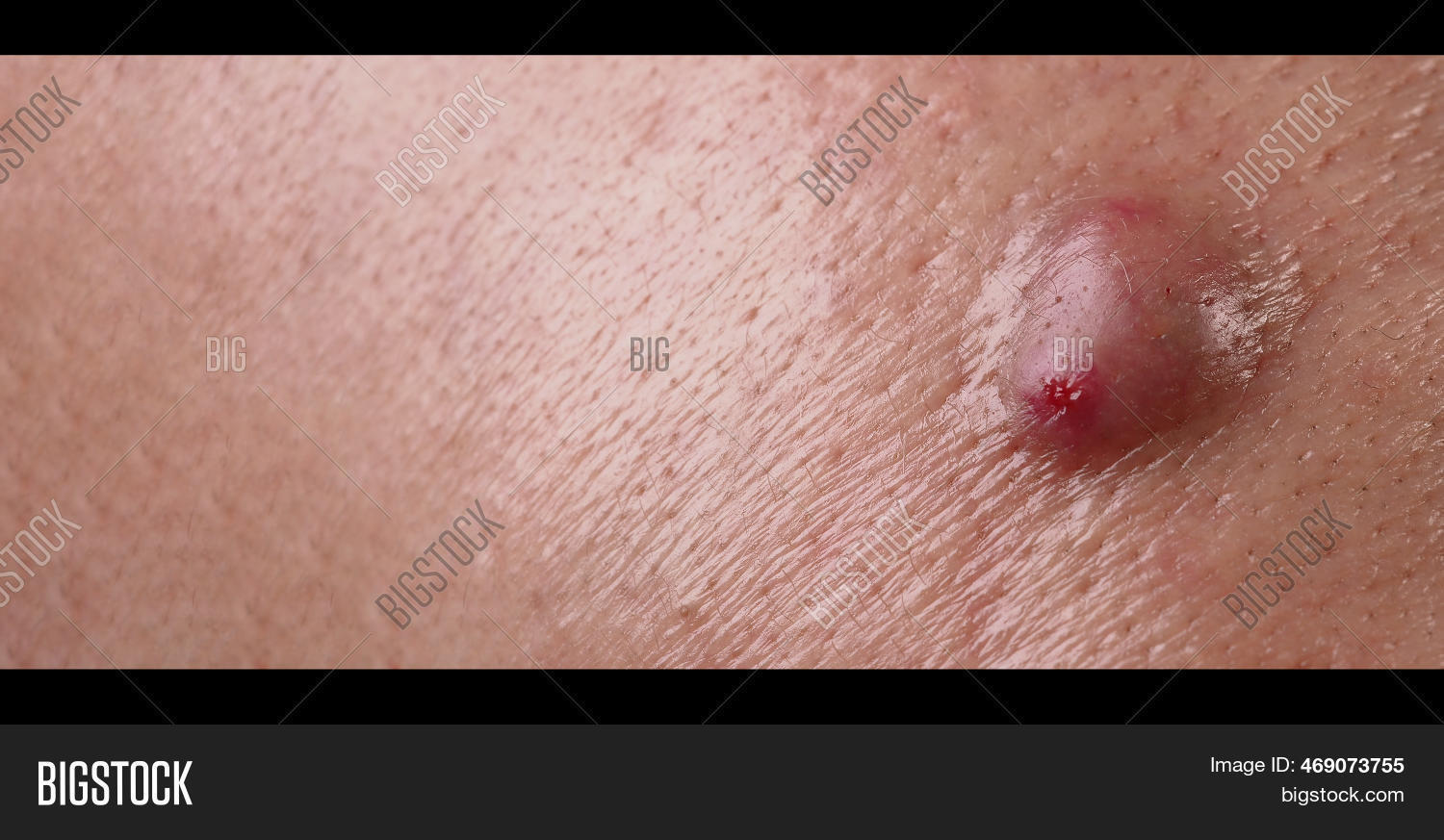 Big Acne Cyst Abscess Image & Photo (Free Trial) | Bigstock