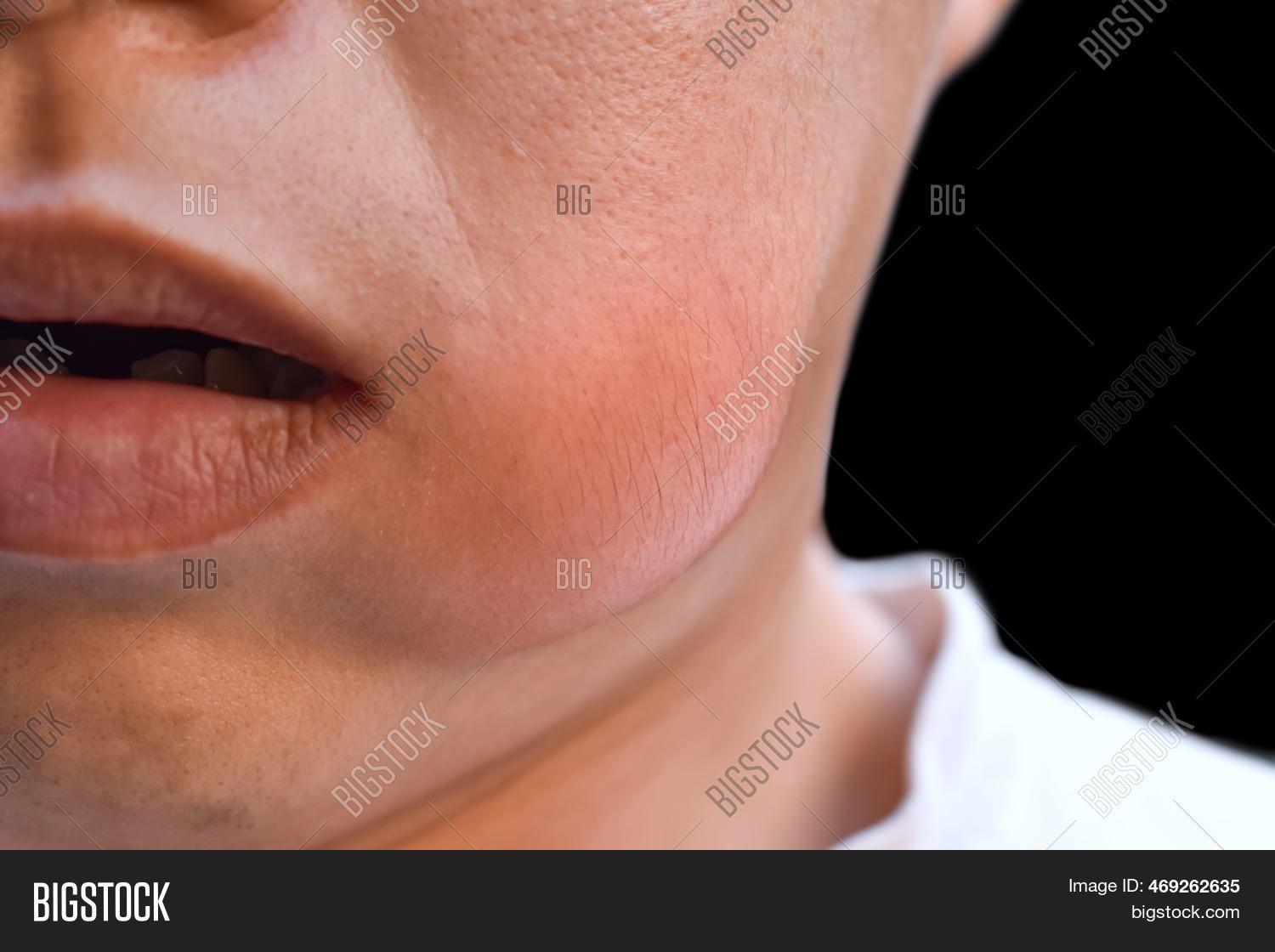 Swelling Cheek Asian Image & Photo (Free Trial) | Bigstock