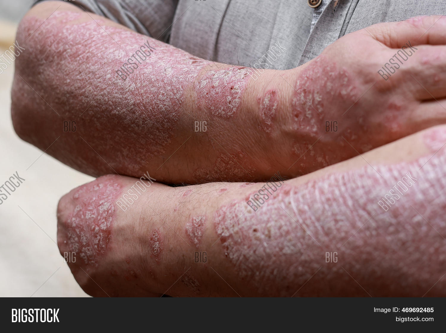 Psoriasis Skin Red Image & Photo (Free Trial) | Bigstock