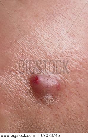 Big Acne Cyst Abscess Image & Photo (Free Trial) | Bigstock