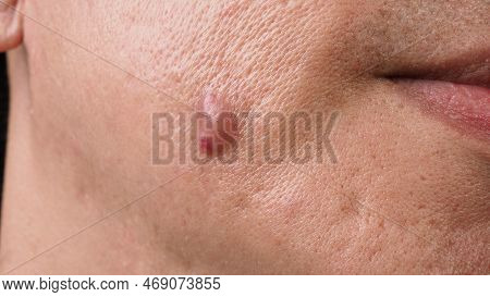 Big Acne Cyst Abscess Image & Photo (Free Trial) | Bigstock