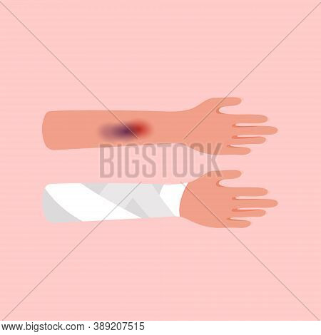 Severe Injury Bruise Vector & Photo (Free Trial) | Bigstock