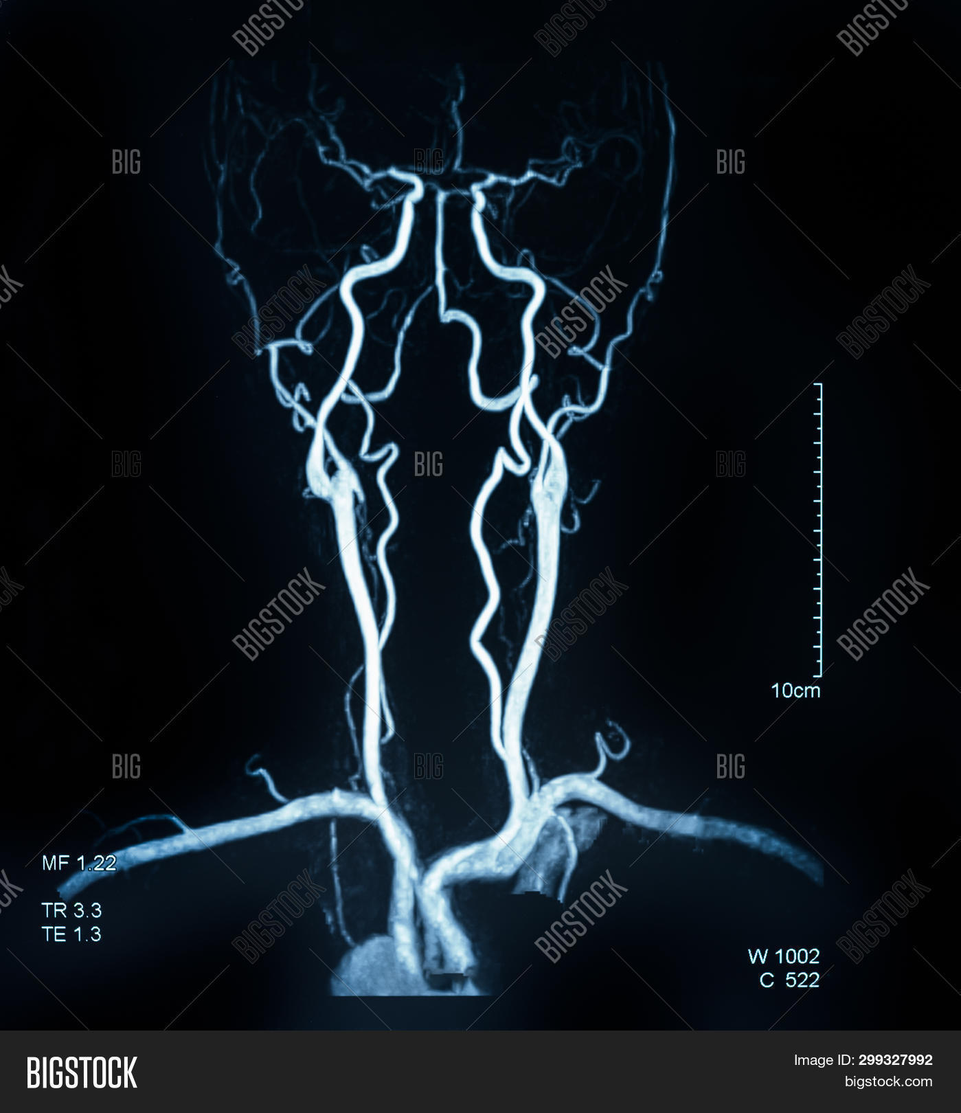 Mri Blood Vessels Image & Photo (Free Trial) | Bigstock