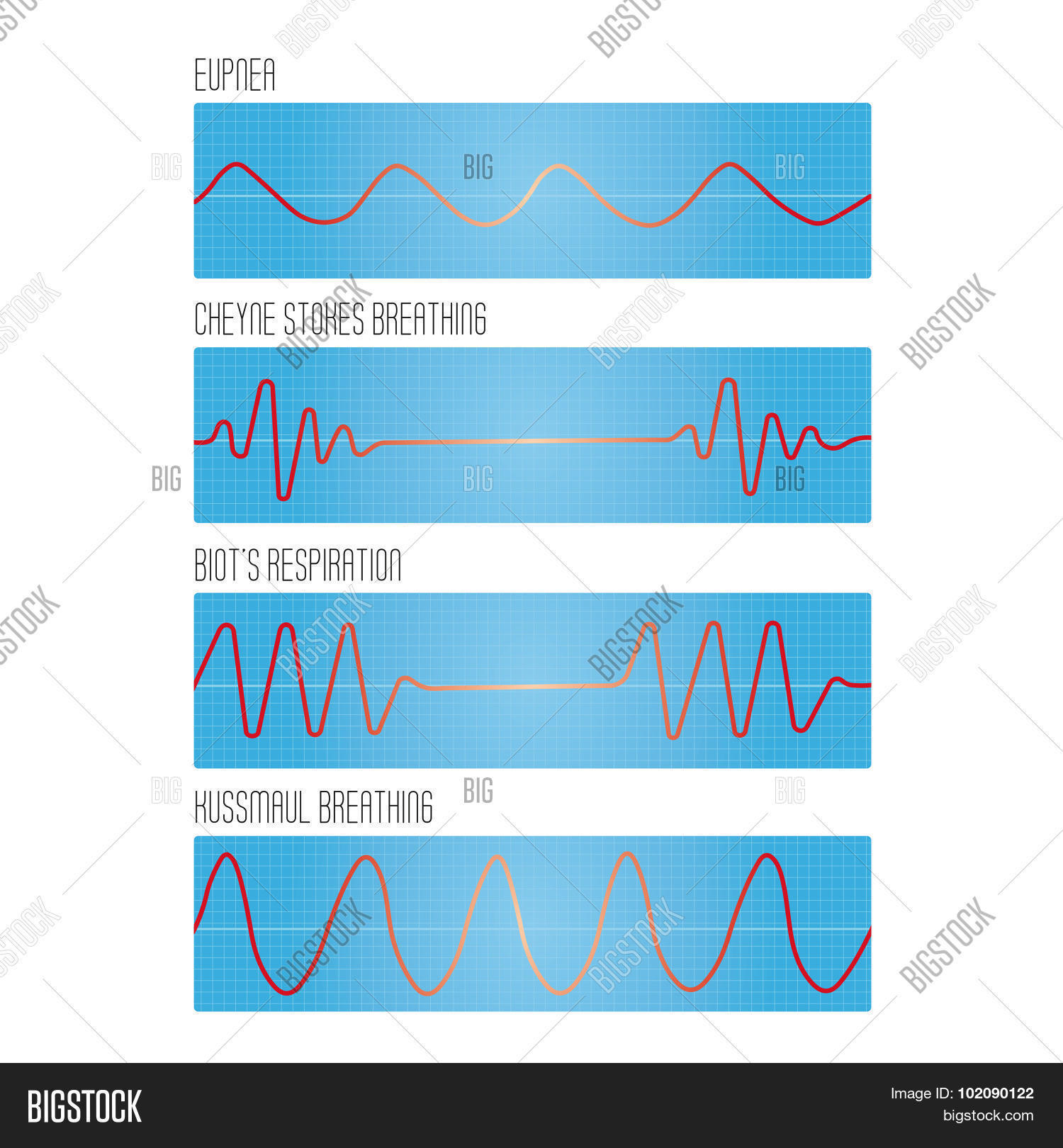 Graph of breathing, the pathological types of breathing: normal ...