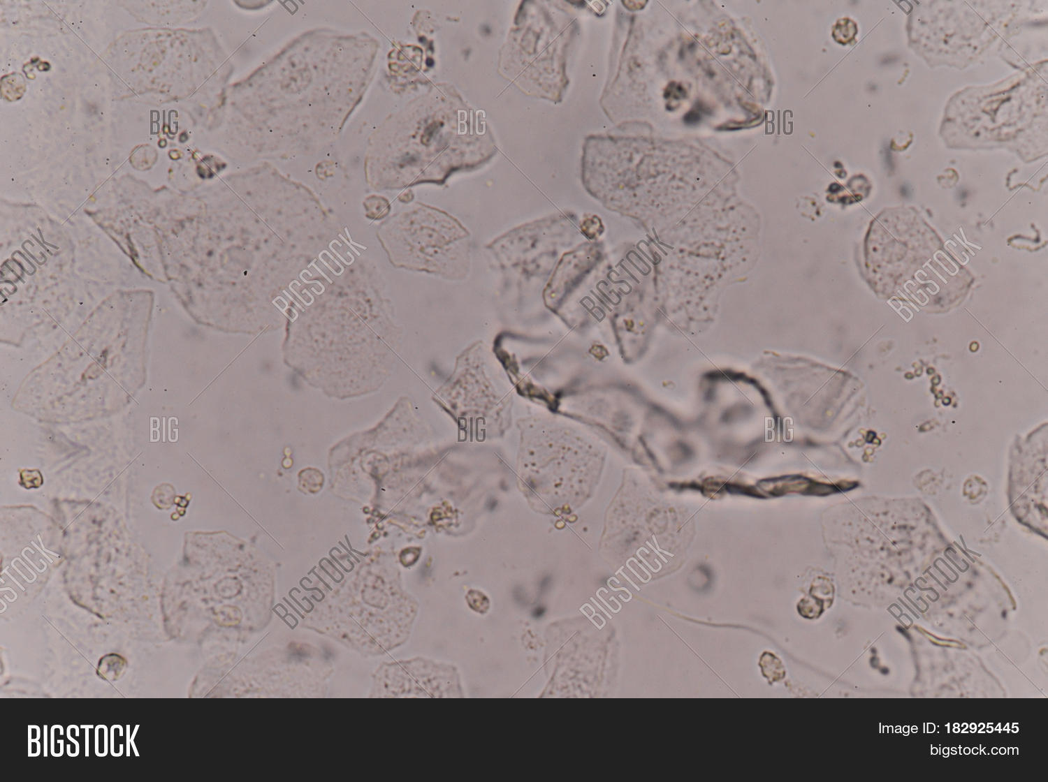 Epithelial Cells In Urine
