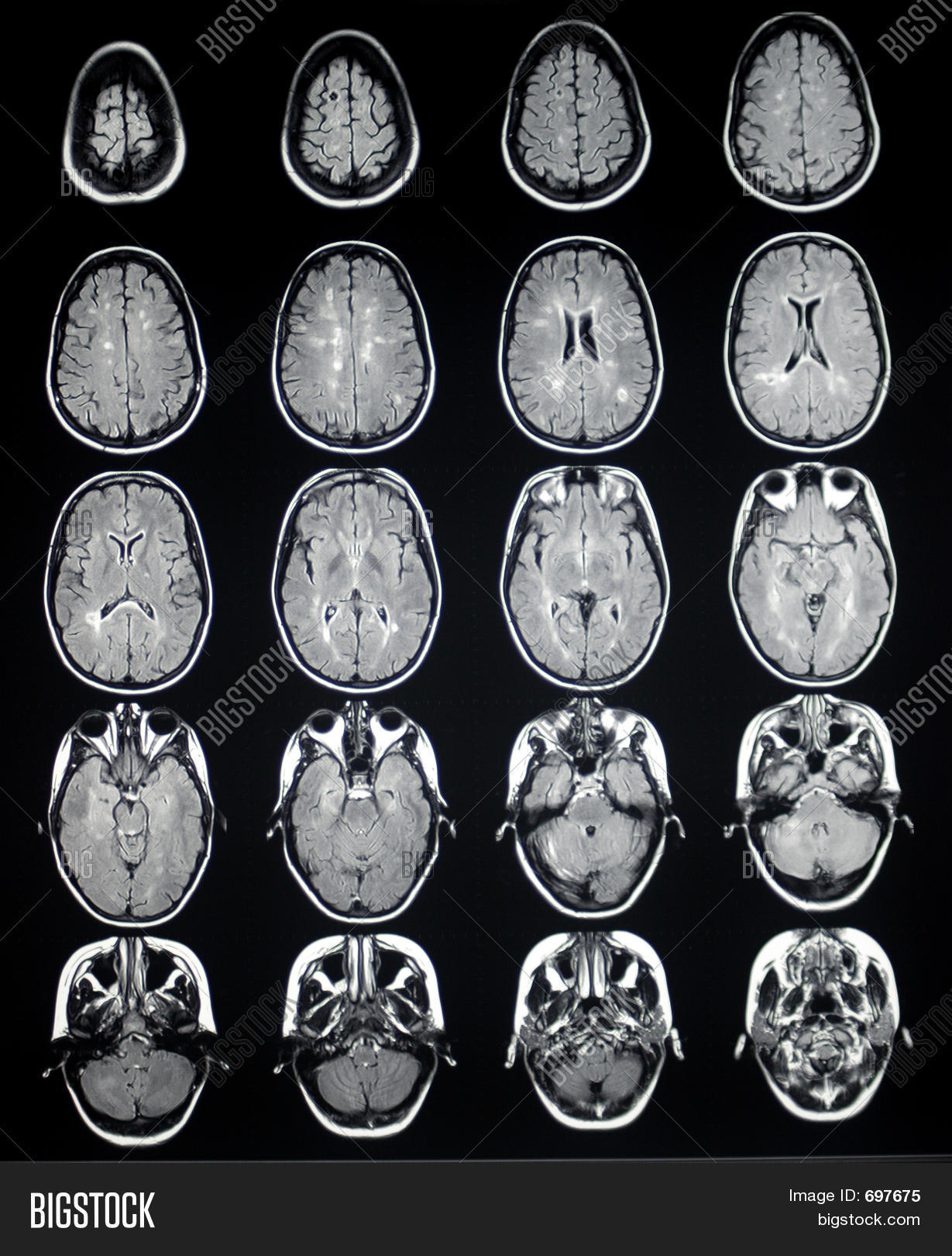 MRI Brain Axial MS Image & Photo | Bigstock